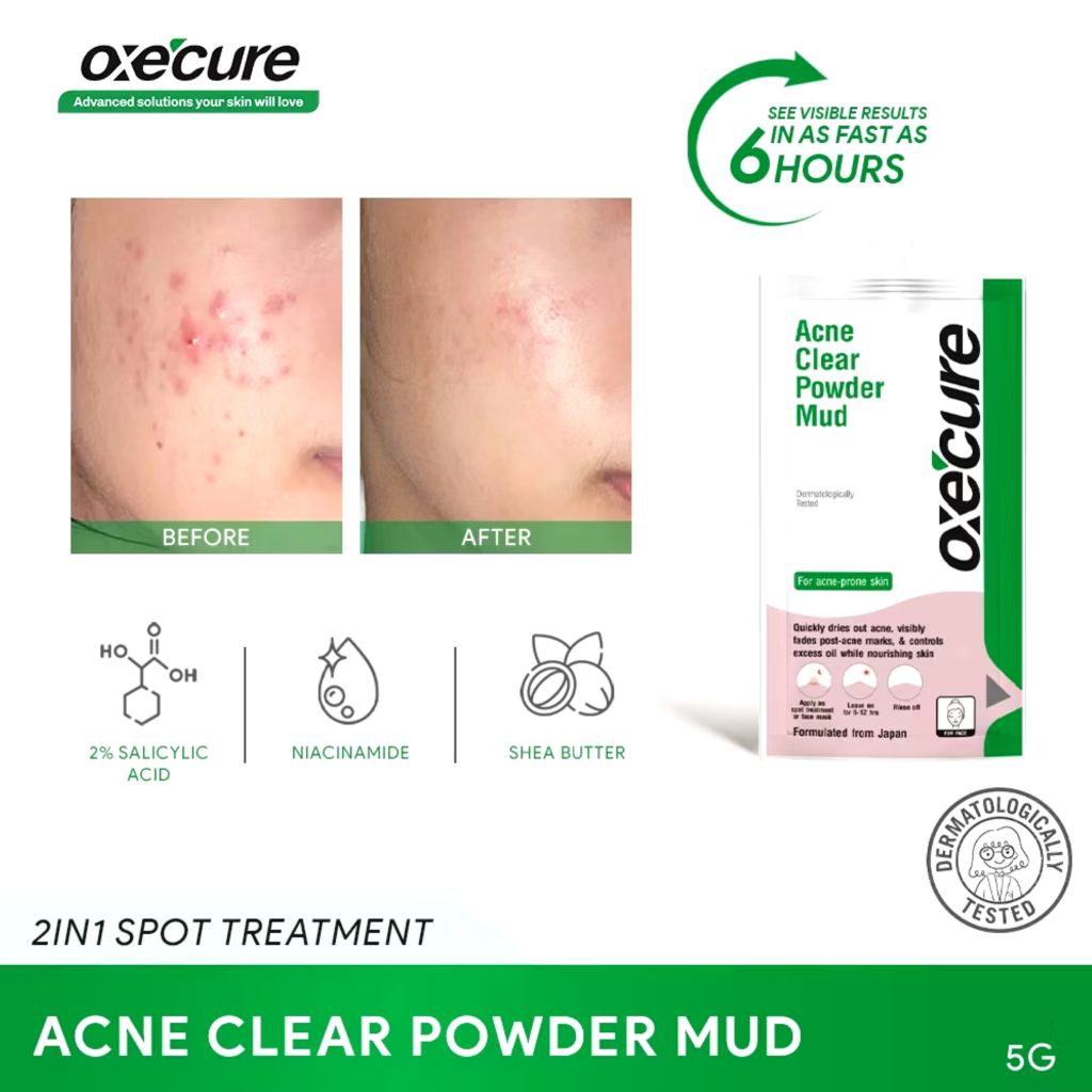 OXECURE Acne Clear Powder Mud Sachet 5grams | Shopee Philippines