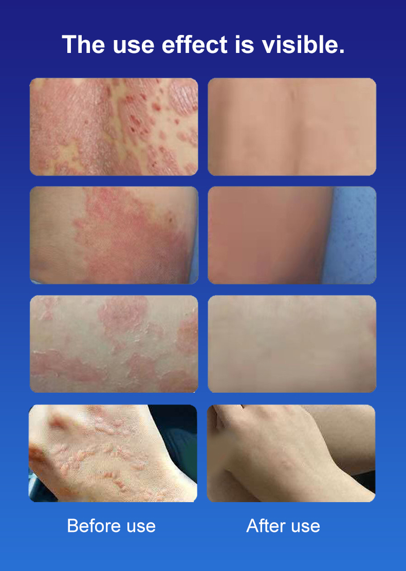 DERMFREE Eczema cream for Sensitive/Dry/Itchy Skin treatment Dermatitis ...