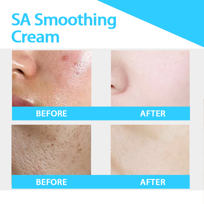 Cerave SA Smoothing Cleanser + Cream Set | Salicylic Acid Duo for ...