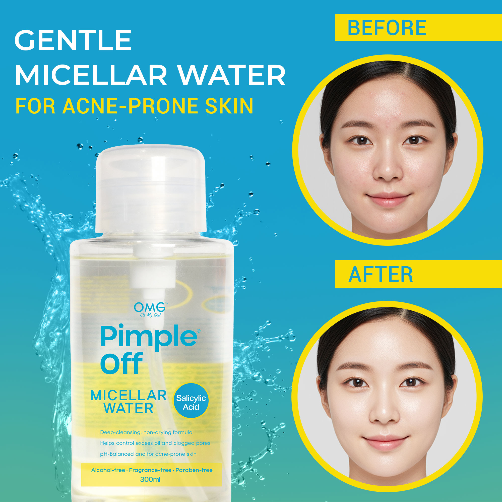 OMG Oh My Girl Pimple Off Micellar Water with Salicylic Acid | Shopee ...