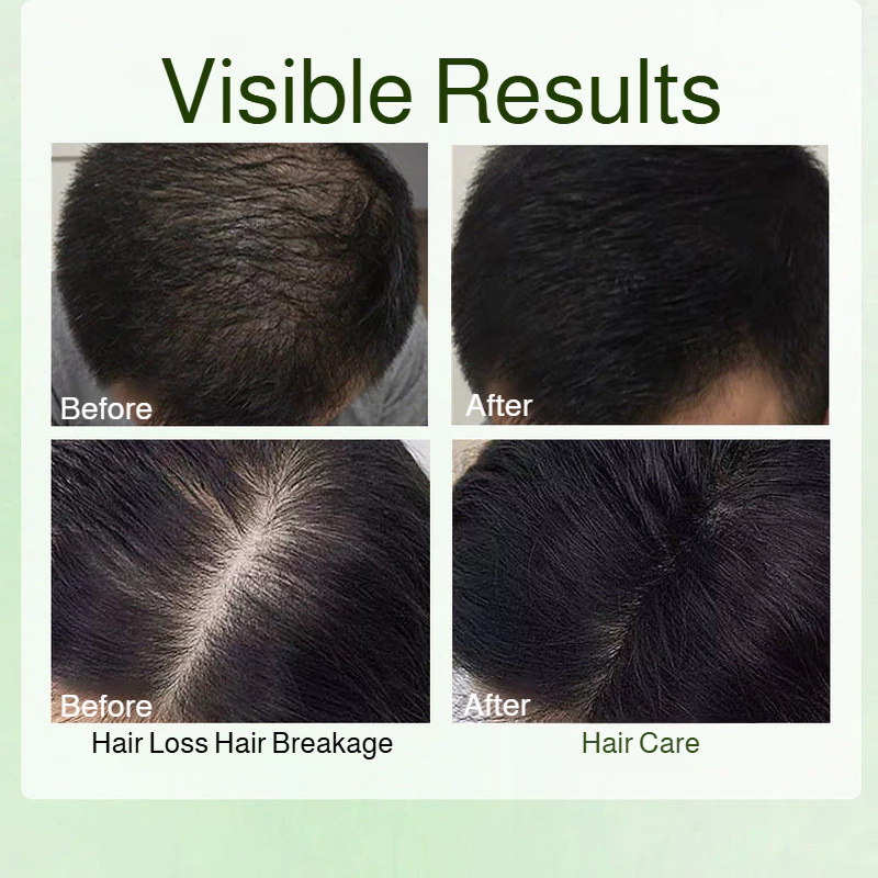 Usman Hair Growth Soap – Anti-Hair Loss Herbal Shampoo with Nourishing ...