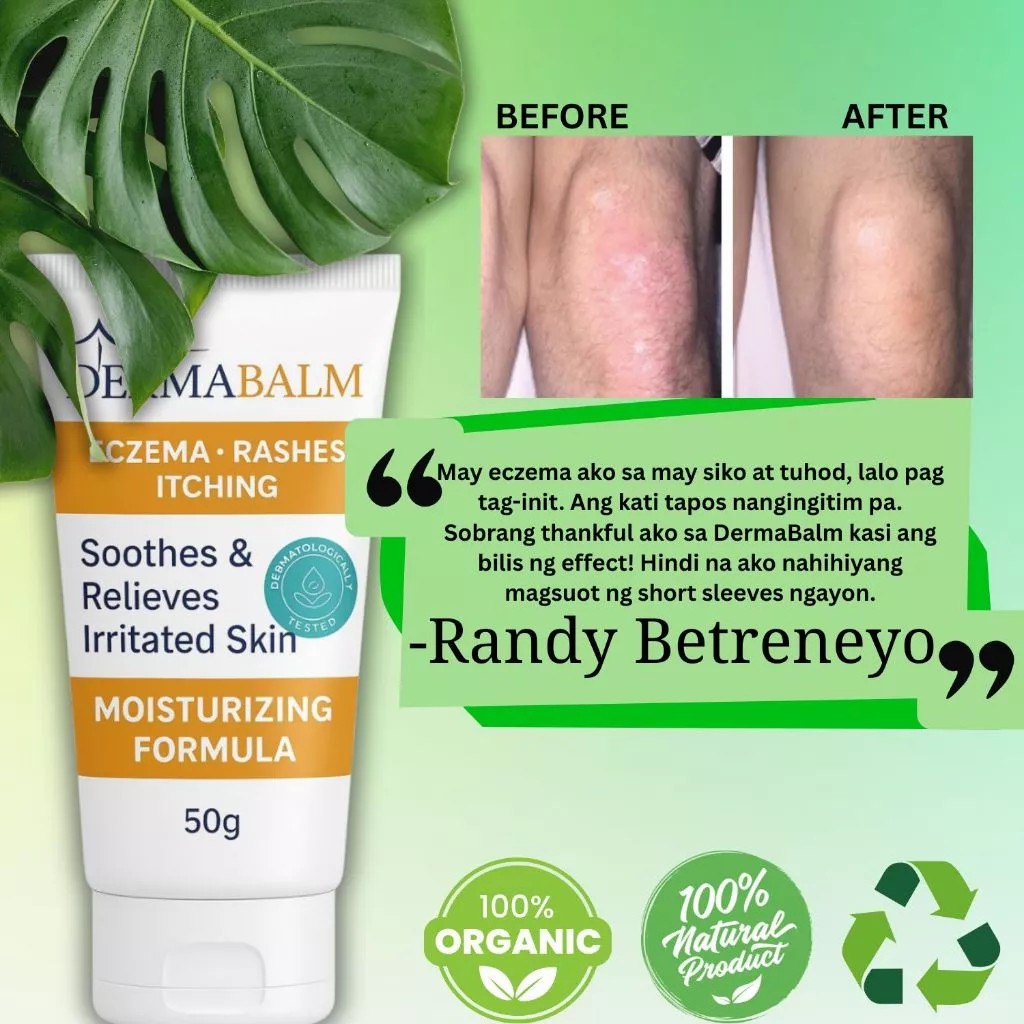 DermaBalm Skin Cream 50g Eczema Rashes Itching Cream Soothes & Relieves ...