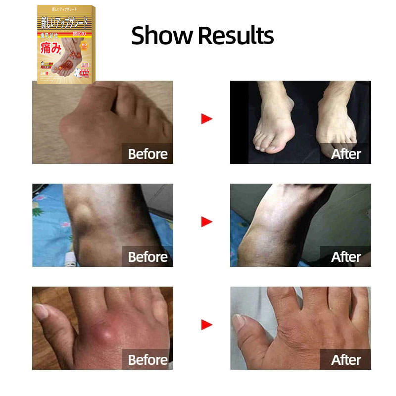 Patches For Pain Relief Mitsui Gout Patch Original Arthritis Pain ...