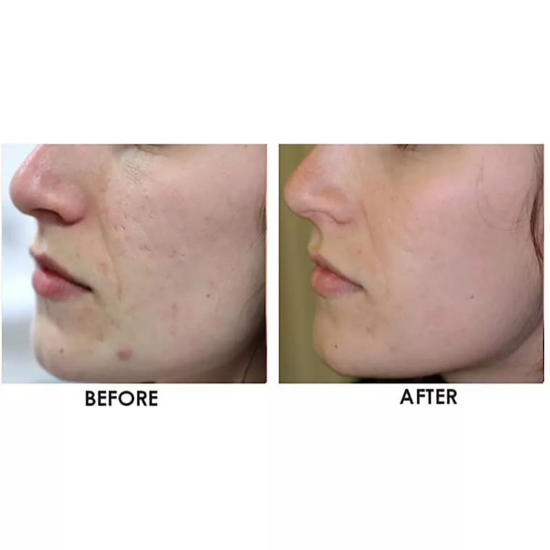 Contractubex The Scar gel that makes the Difference 30g From Germany ...