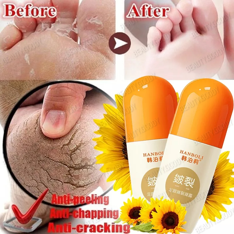 Hand Foot Crack Treatment Moisturizing Cream Heel Chapped Peeling Anti ...