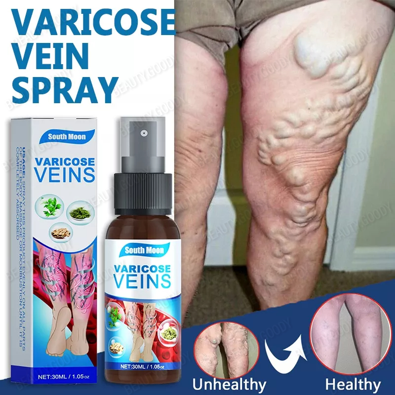 Varicose Vein Spray Herbal Pain Relief Effective Remover Legs Spider ...