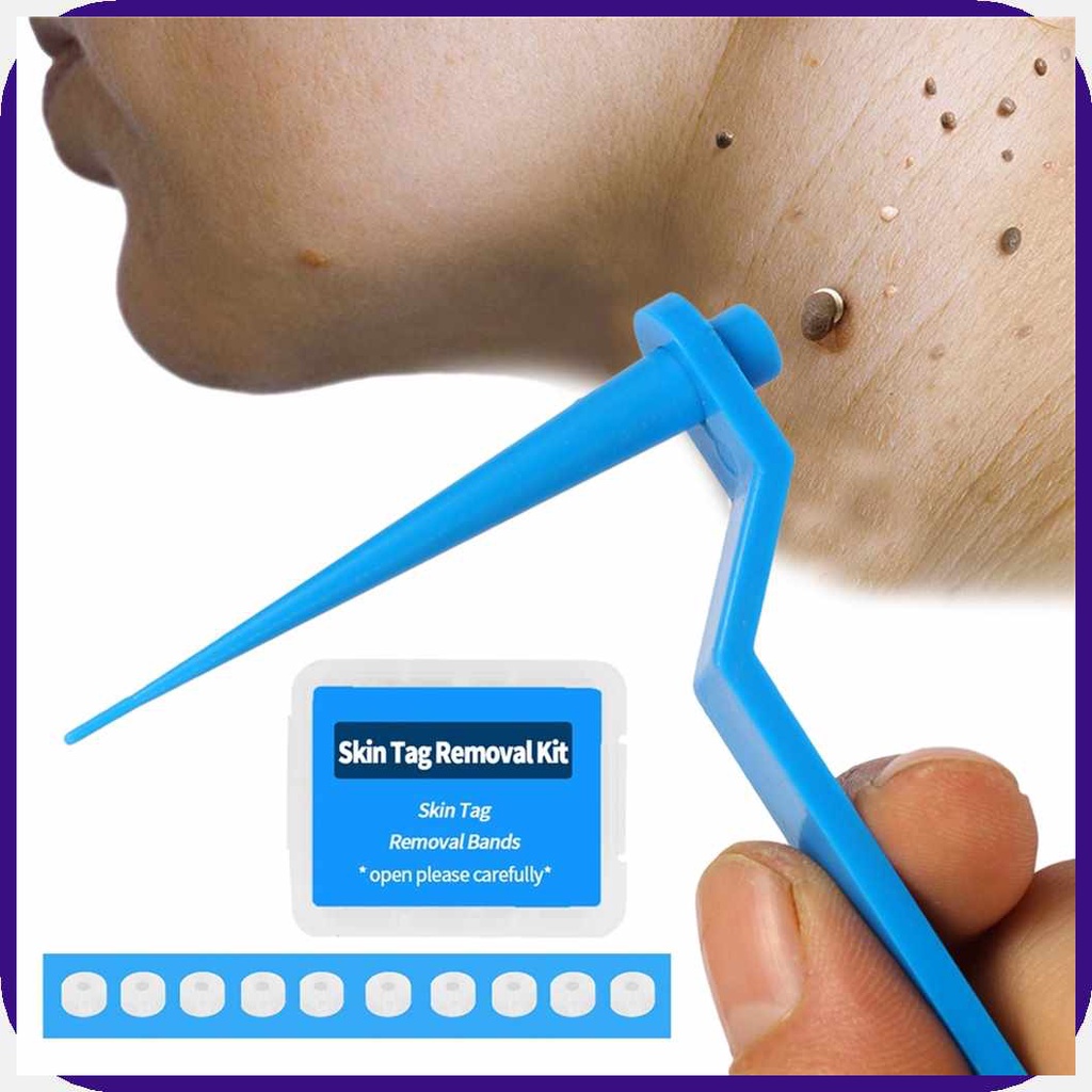 Skin:sA$Tag>K,Kill;oX&Skin`bd&Mole`Tx&Wart{jA'Remover{xQ'Band,{zf'with ...