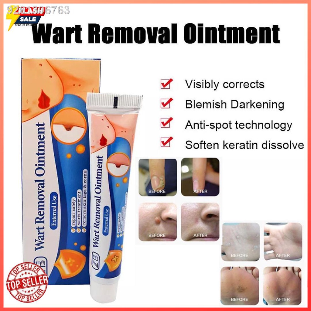 (hot sale)Warts Remover Original Cream Warts Magic Remover Wartz ...