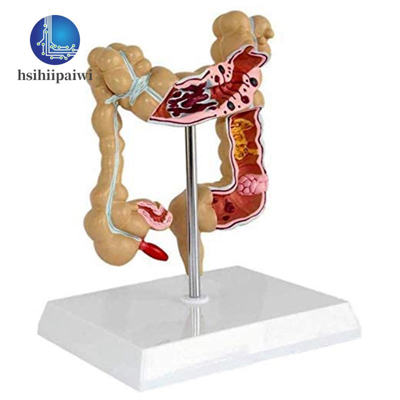 Colon Pathological Colorectal Cancer Model Large Intestine Model ...