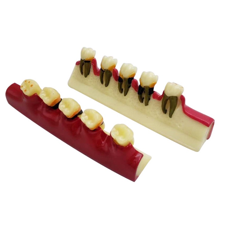 2times Periodontal Disease Progression with caries Tooth Model For ...
