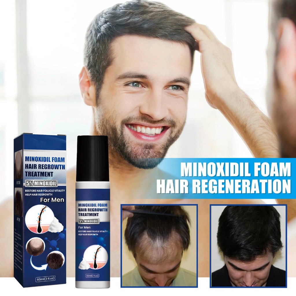 Minoxidil Foam Extra Strength & Biotin Hair Regrowth Treatment for Men ...