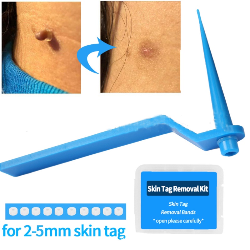 Skin Tag Removal Kit Kill Skin Mole Wart Remover Micro Band Remove Skin ...