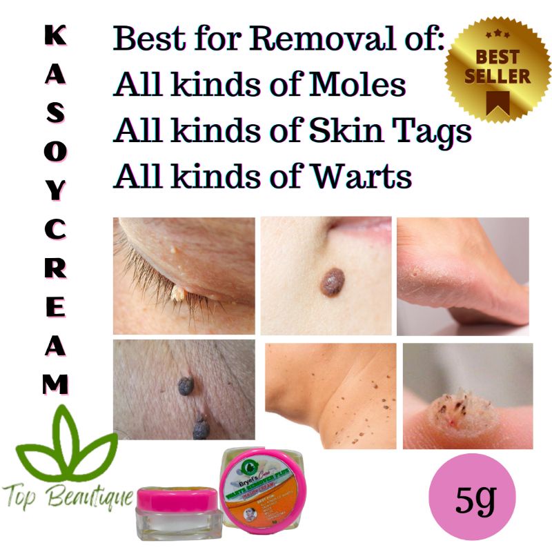Pure Organic Kasoy Cream For Effective Removal of Warts,Moles,Skin Tags ...