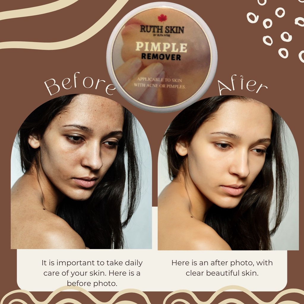 Ruth Skin Pimple Remover. | Shopee Philippines