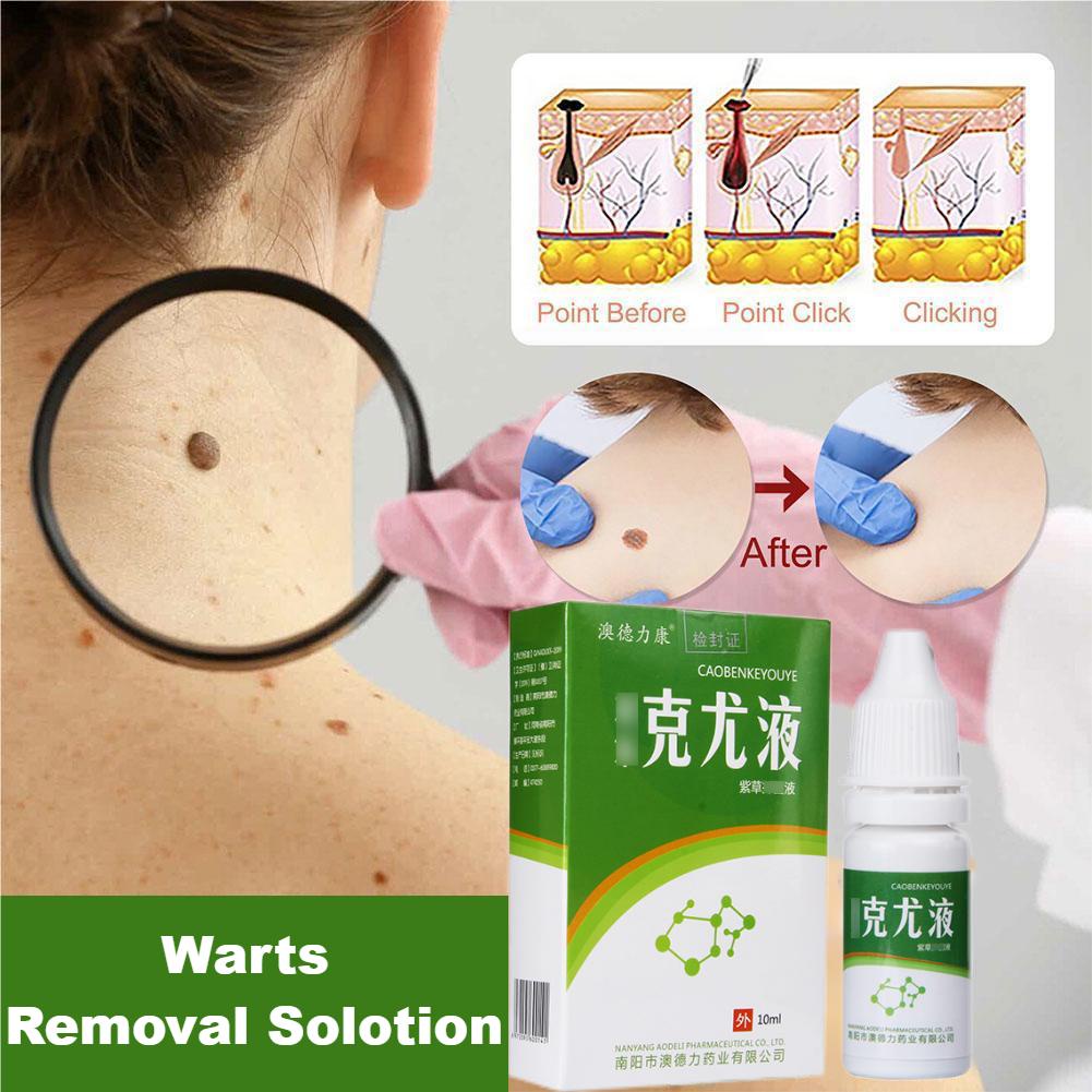10ML Effective Warts Remover Liquid Remove Mole Skin Tags Get Rid Of ...
