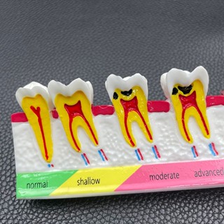 Teeth Caries Classify Tooth Model of Pathological Process Around Teeth ...
