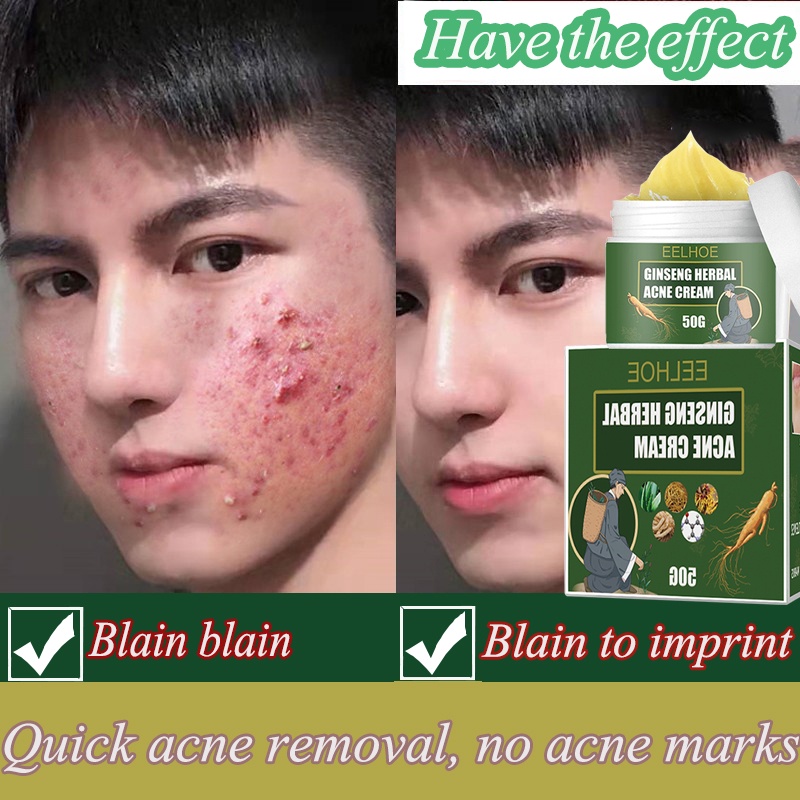 Anti Acne Cream Original Skin Remover Brightening Moisturizing Skin ...