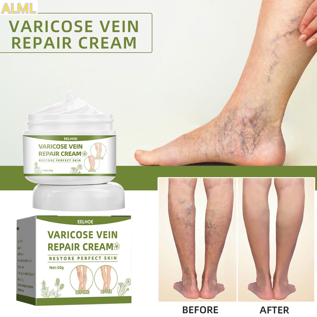 Varicose Vein Cream Swelling Earthworm Leg Care Varicose Venous Pain ...