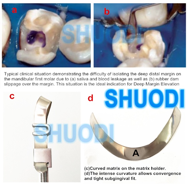 Dental Tofflemire Matrix for Deep Margin Elevation Large Curvature ...