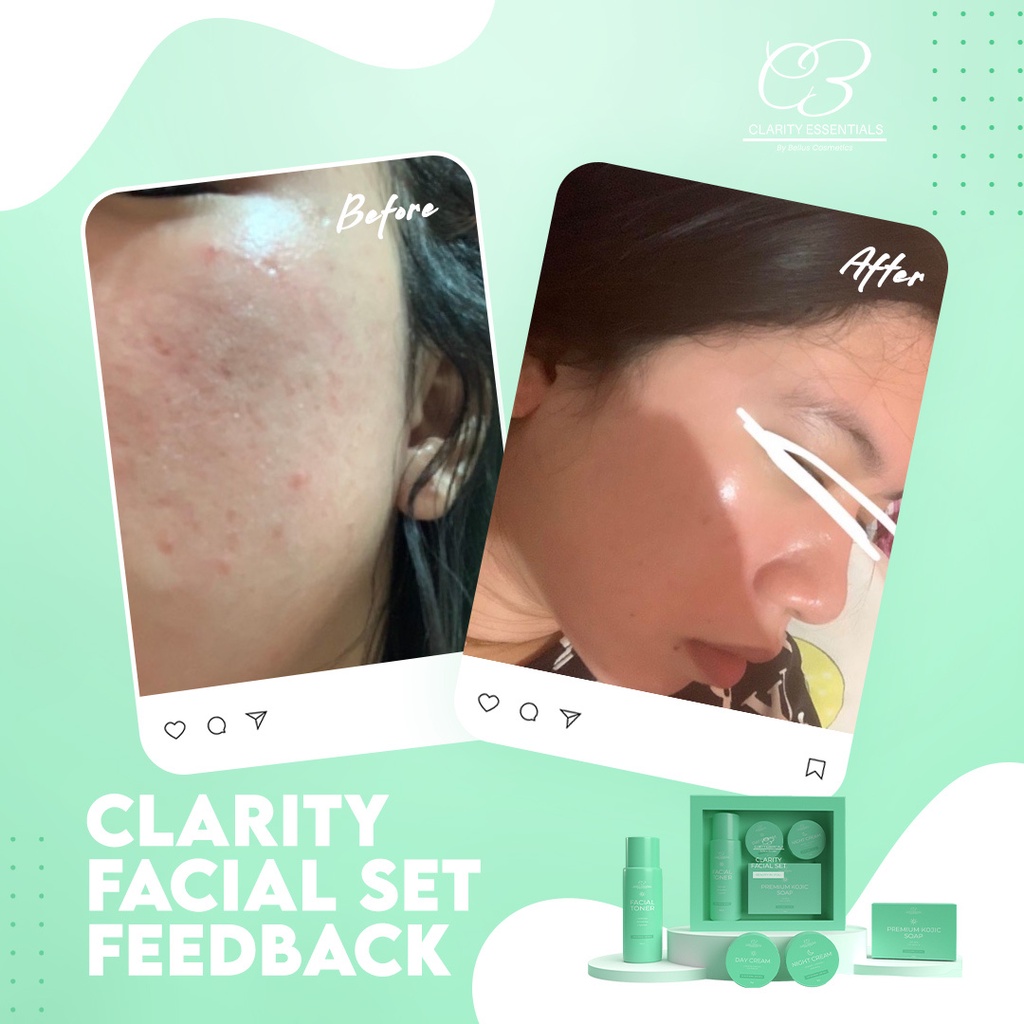 FDA Approved Clarity Facial Set | Clarity Essentials | Facial Skin Care ...