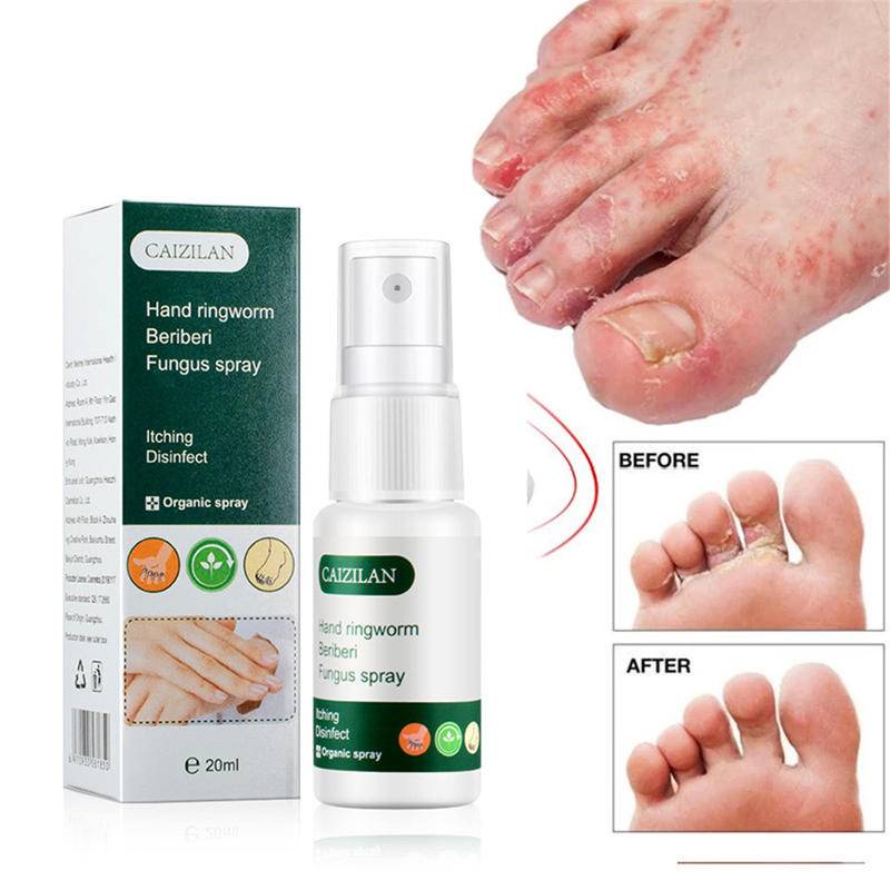 CAIZILAN Anti Fungal Spray Foot Fungal Cream Relieve Beriberi Toe ...