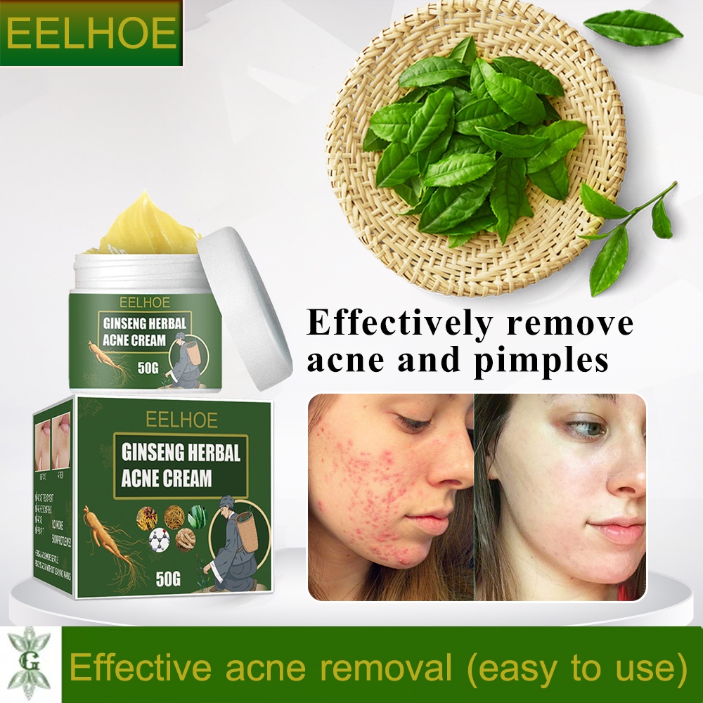 Anti-Acne Cream Acne Treatment Original Skin Remover Brightening ...