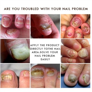 【MEGASALE】RtopR Ginger Antibacterial Nail Repair Onychomycosis ...