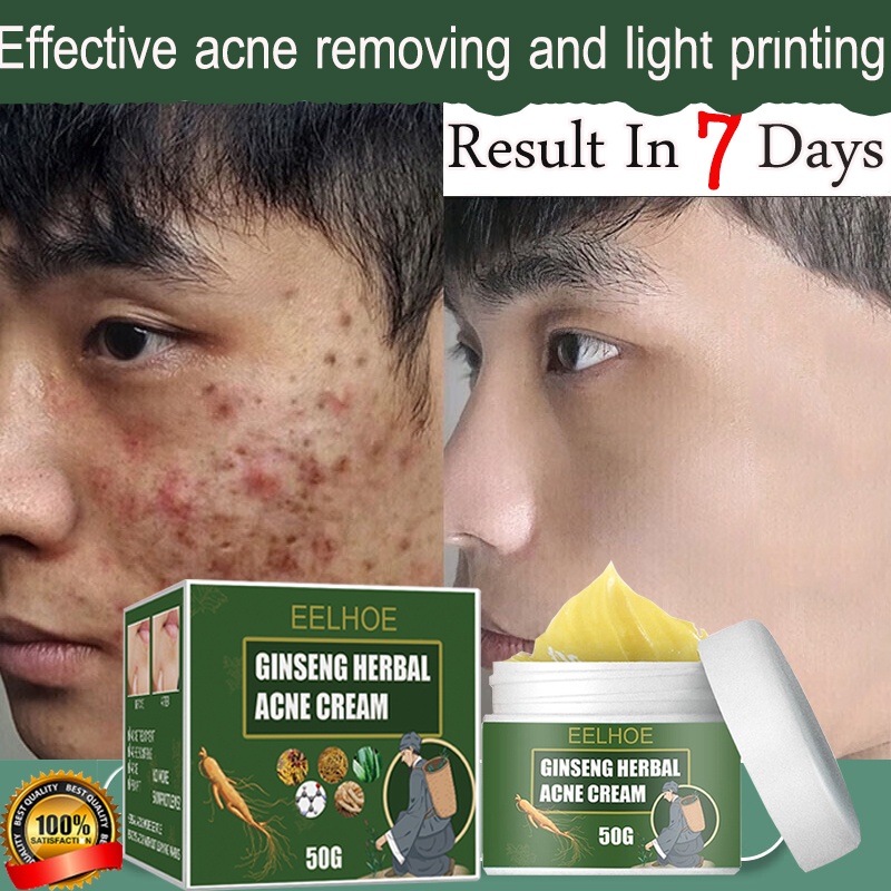Acne remover Pimple Marks Remover Keep Face Moisturized Treatment Skin ...