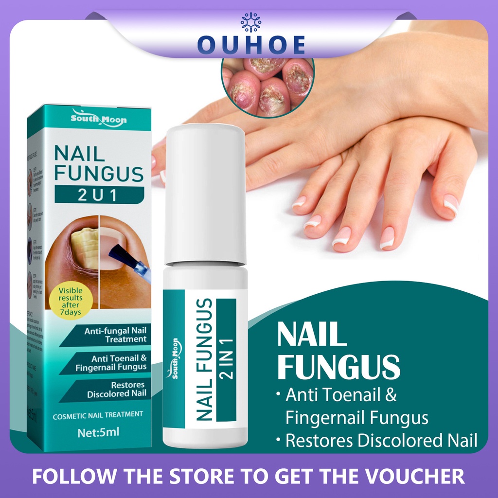 South Moon 5ml Nail Repair Liquid Effective Treatment Onychomycosis ...