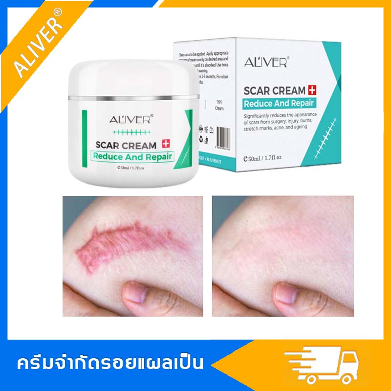 ALIVER Scar Removal Cream Reduction 50ml Burns Acne Marks Stretch Scars ...