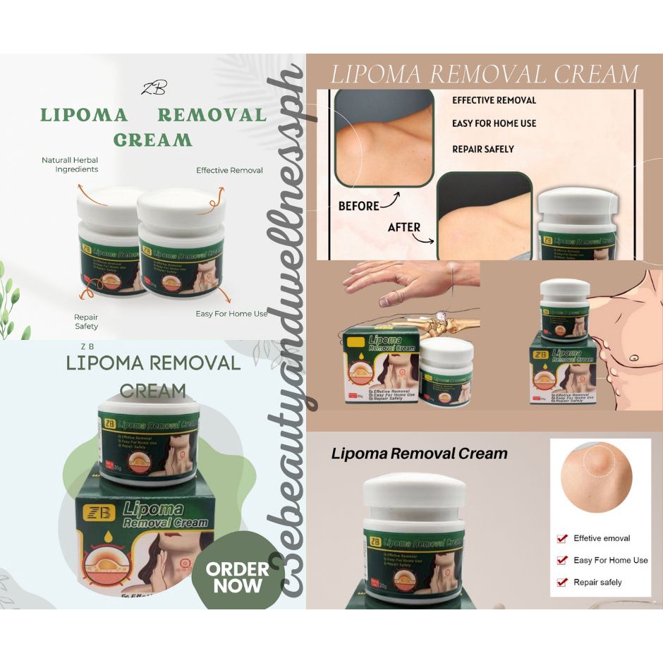 Lipomas cream original removal/Effectively remove subcutaneous multiple ...