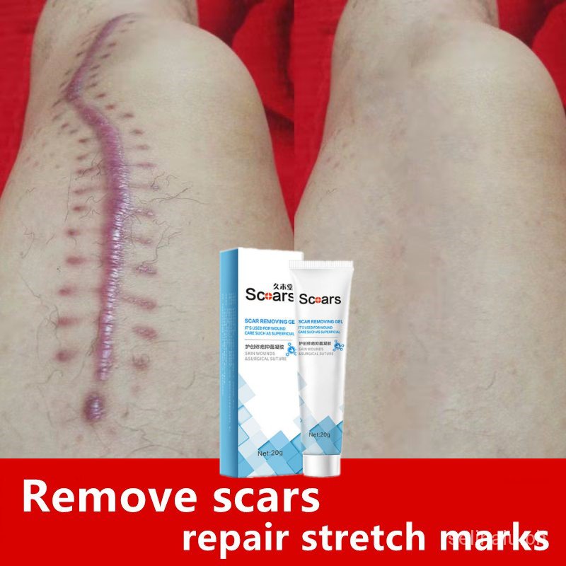 Acne scars cream remove acne scars scar gel dark scar removal stretch ...