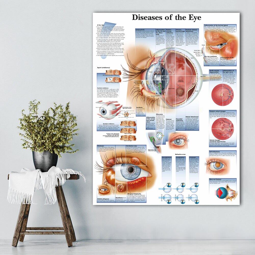 Human Diseases of the Eye Chart Posters Refractive Canvas print Wall ...