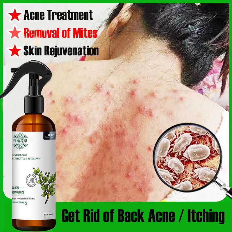 300ML Mite Spray Bed Bug Killer Dust Mite Remove Spray Non-toxic ...