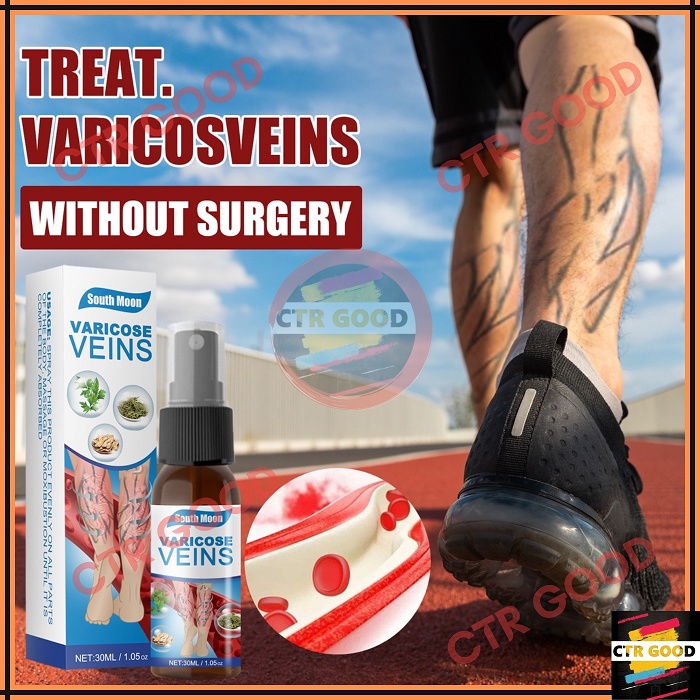 Varicose Veins Effective Remover Pain Relieving Spray Varicose Vein ...