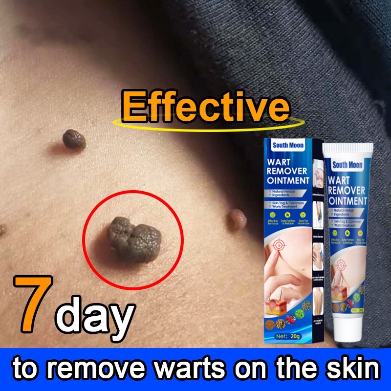 20g Warts Remover Original Cream Fast effective wart removal Painless ...
