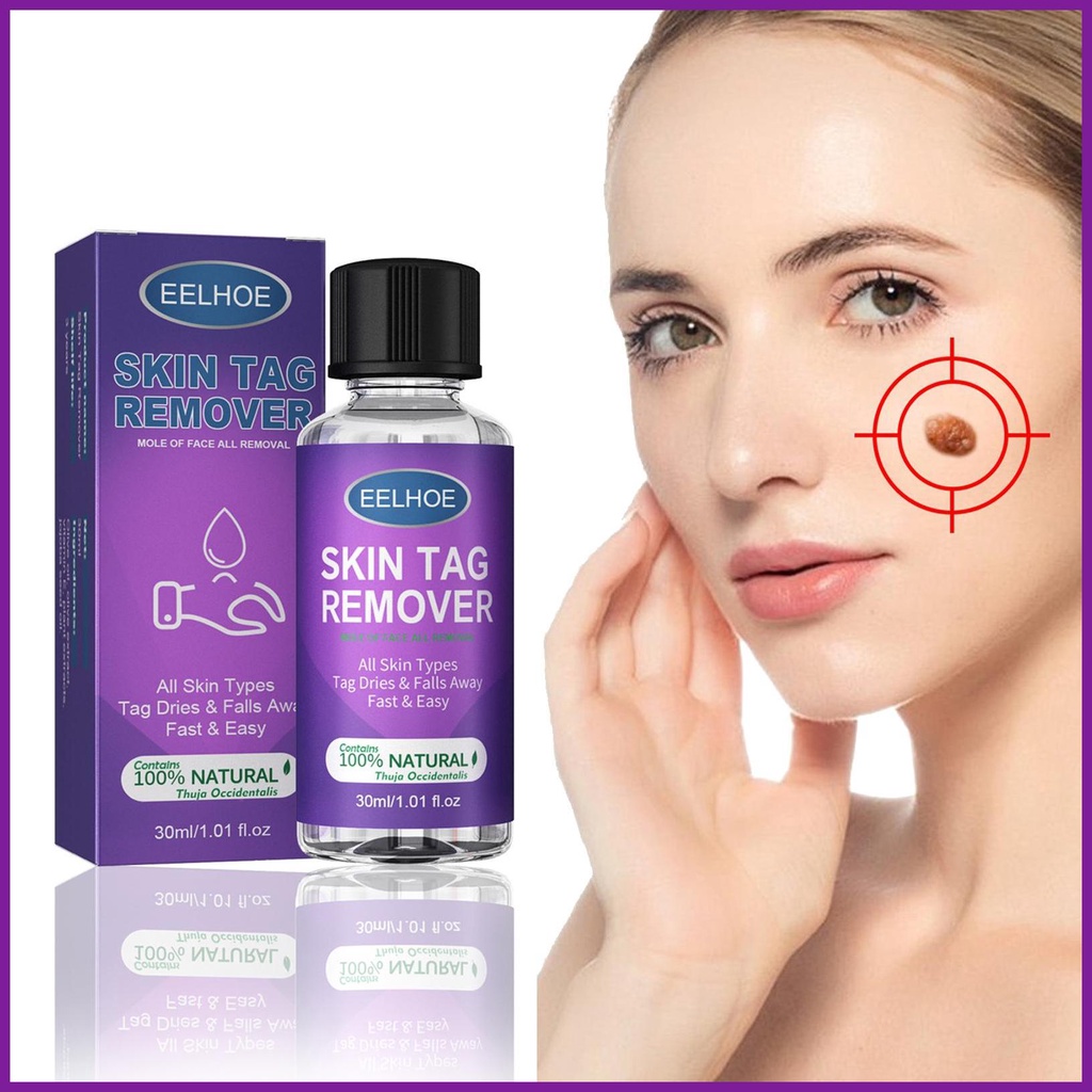 Skin Tags Remover Against Mole and Wart Fast Removal Skin Tags Remover ...