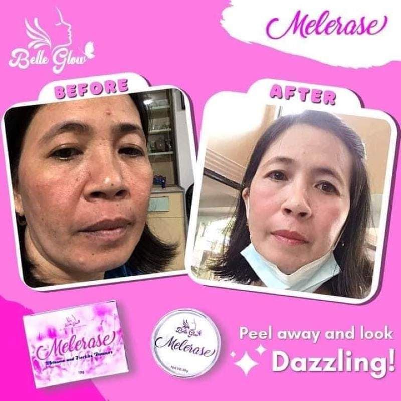 Original 100% Authentic Pekas Remover Cream(Belle Glow Skincare ...