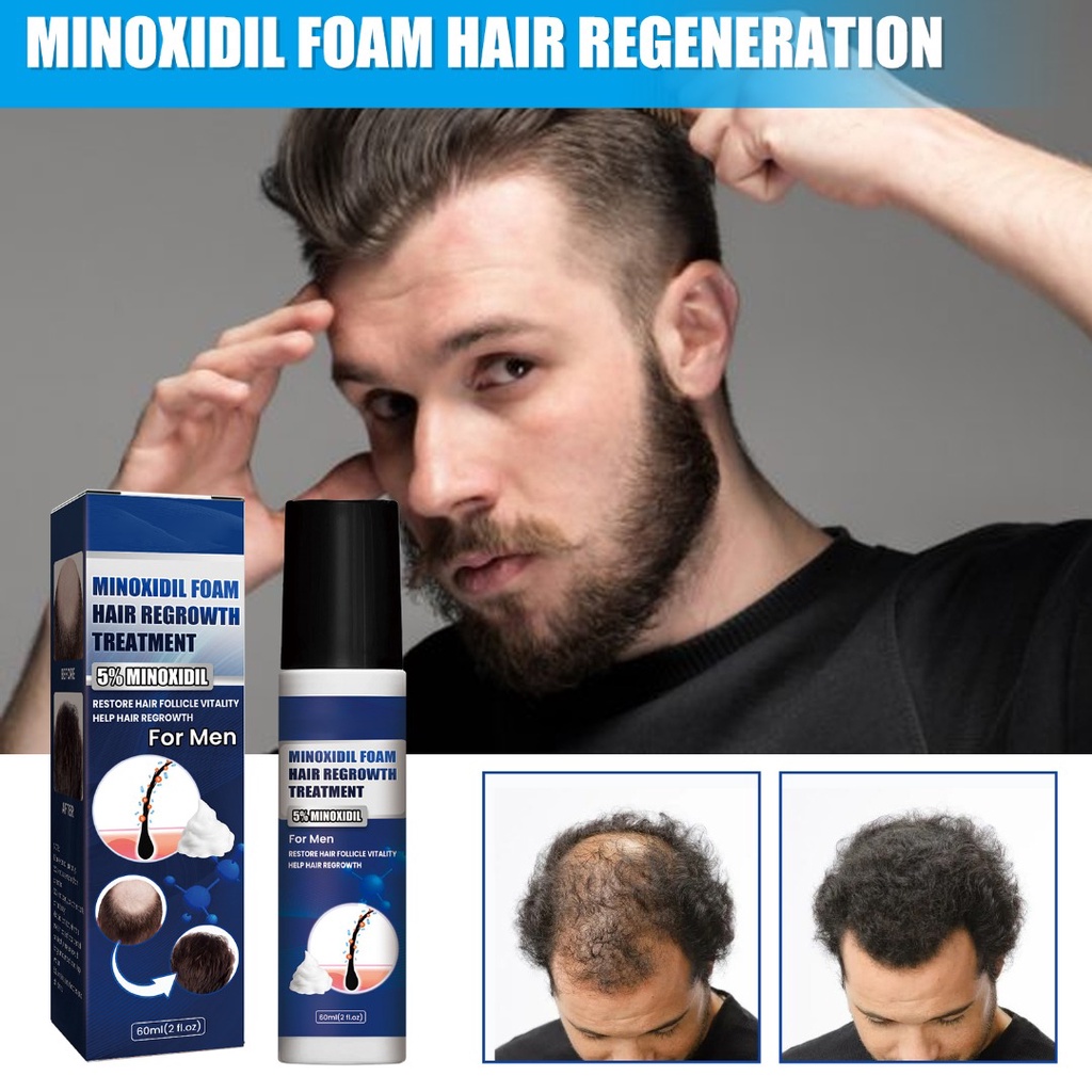Minoxidil Foam Extra Strength & Biotin Hair Regrowth Treatment for Men ...