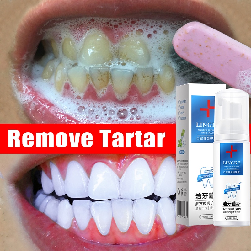 Teeth Whitening Teeth Cleaning Mousse White Teeth Oral Hygiene Tartar ... Teeth Whitening Teeth Cleaning Mousse White Teeth Oral Hygiene Tartar ...