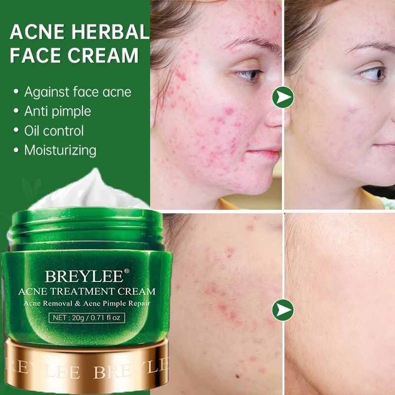 BREYLEE Acne Treatment Cream Anti Acne Face Cream Pimple Removal Spots Oil Control Shrink Pores ...