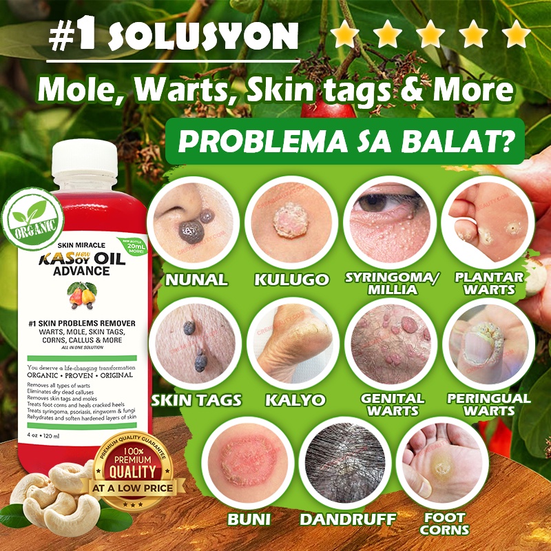 #1 Kasoy Oil (120ml) Mole Remover, Skin tags, Warts, Kalyo & More ...
