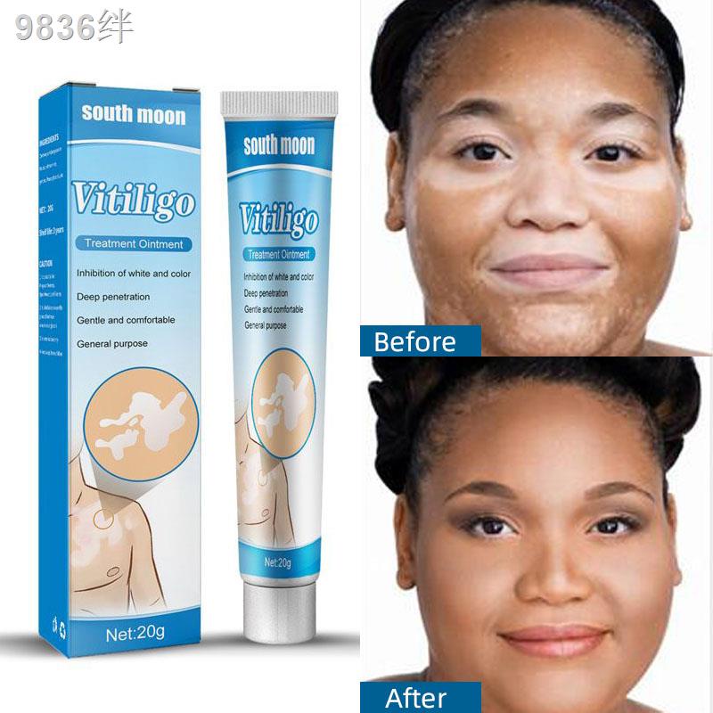 skin fighter White Spot Disease Cream Vitiligo Ointment Treament Repair ...