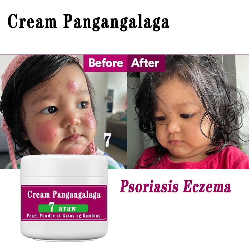 Psoriasis Eczema Cream Antifungal Antibacterial Itchy Shopee Philippines