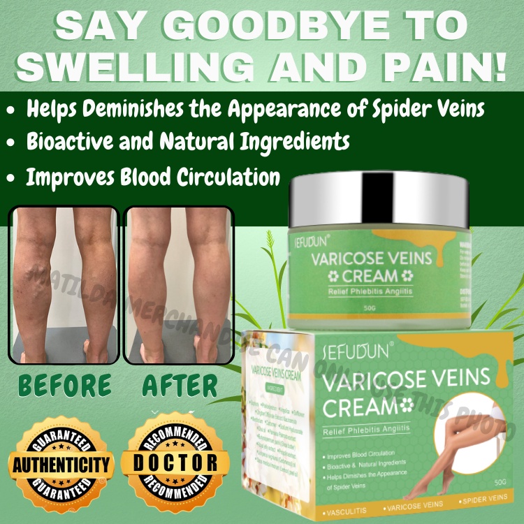 Varicose Vein Pain Killer Arthritis Varicose Vein Remover Original ...