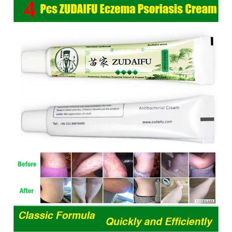 (SET OF 4 ) Natural Chinese Herbal Medicine Cream Eczema Dermatitis ...
