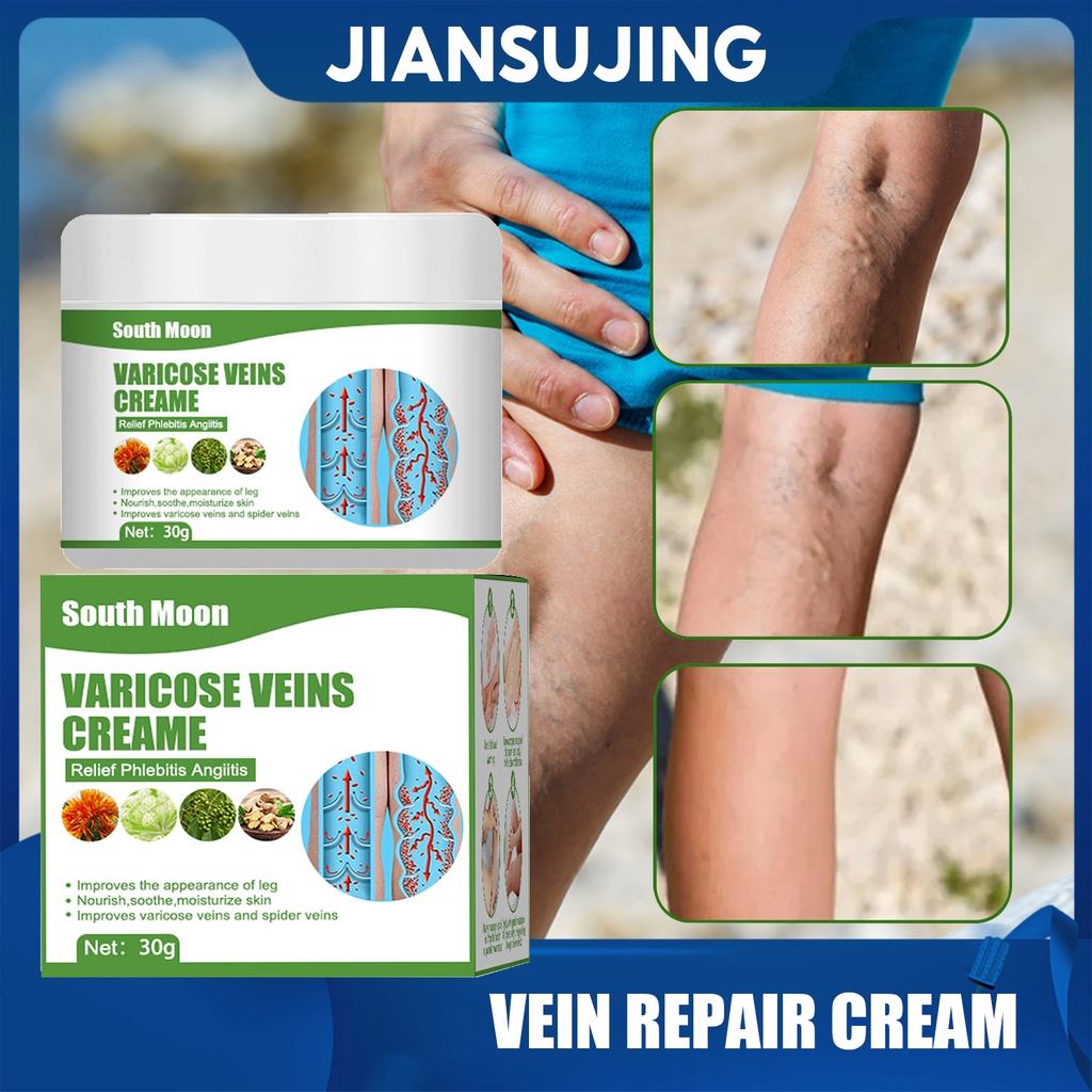 SOUTH MOON Varicose Veins Cream Relief Phlebitis Angiitis Treatment ...