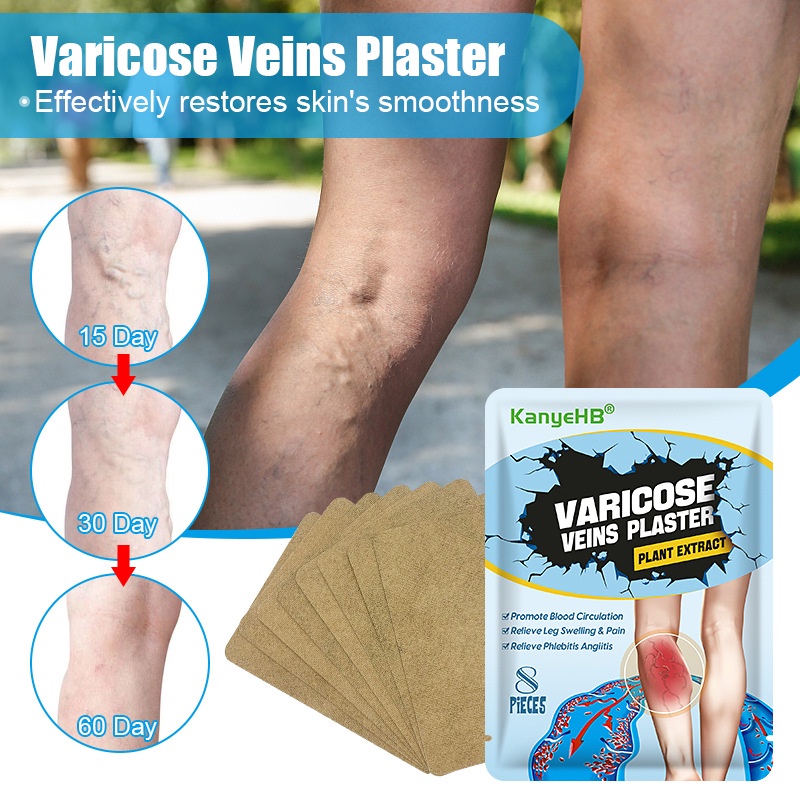 Varicose Vein Remover Cream Plaster Patch Pain Relief Leg Swelling ...