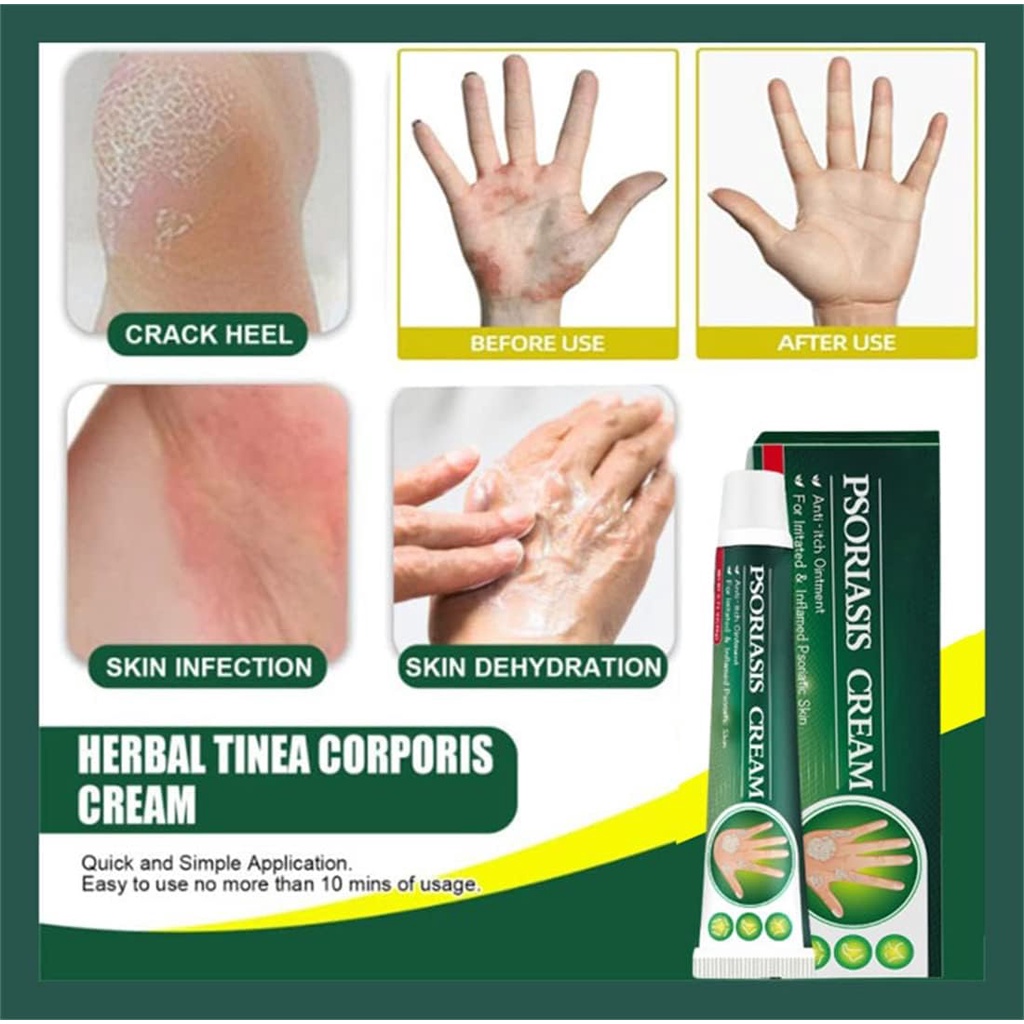 20g Skin tinea care cream for external use Antifungal Cream Zlimplify ...
