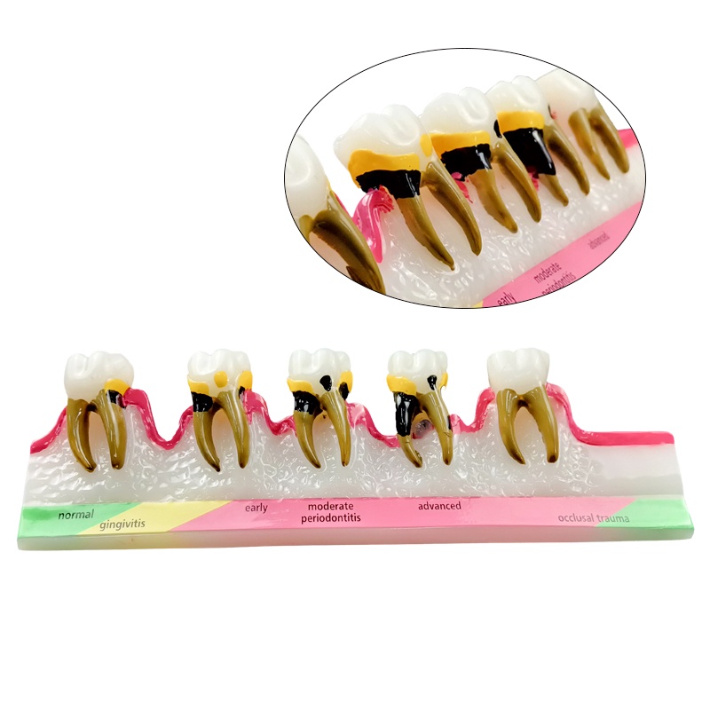 Teeth Model Caries Classify Pathological Model Tooth Caries Evolution 5 ...